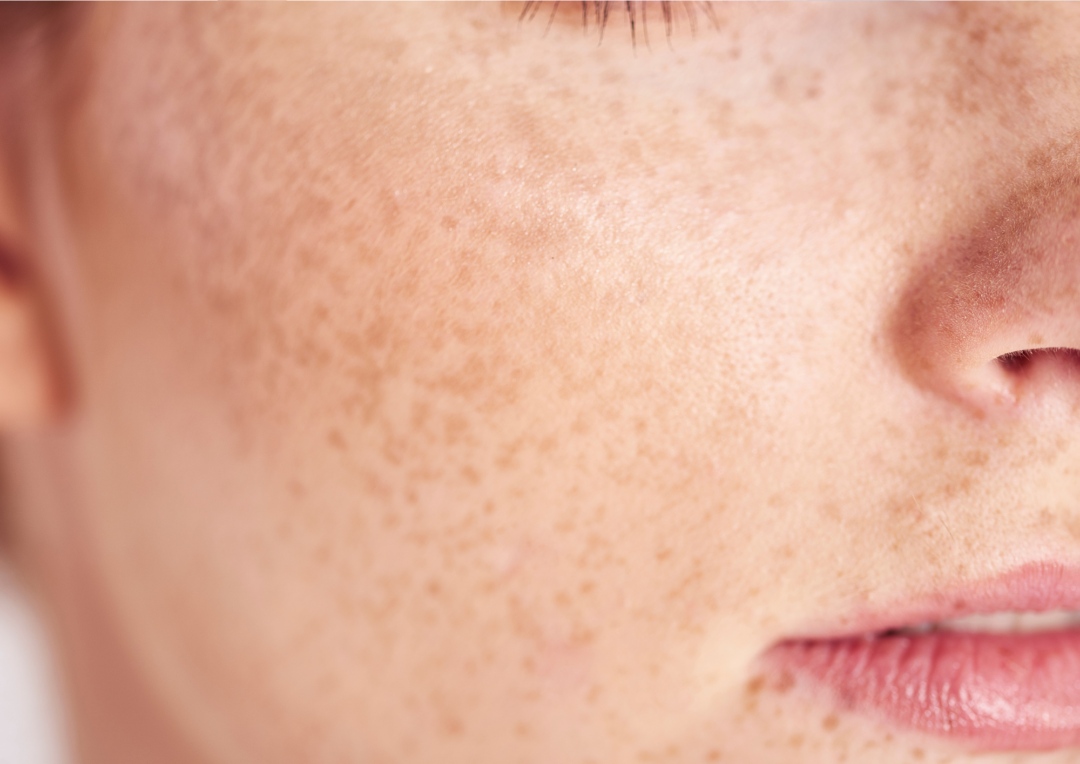 Taches pigmentaires • Centre Laser Paris Ouest : Médecine Esthétique